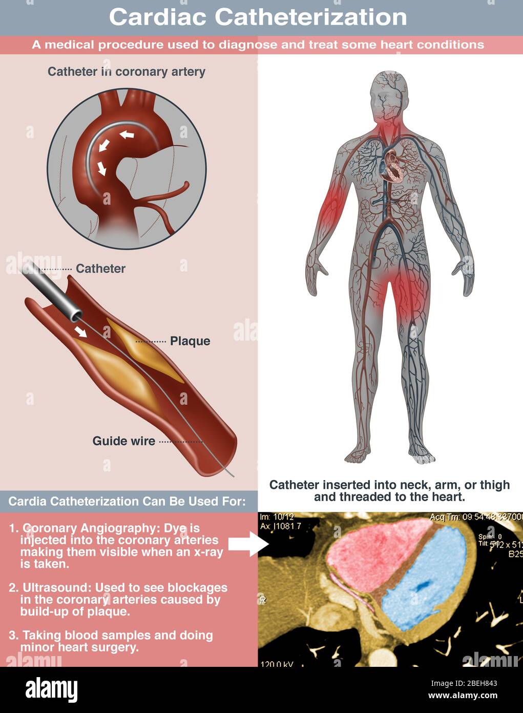 Cathétérisme cardiaque illustration Banque d'image et photos - Alamy