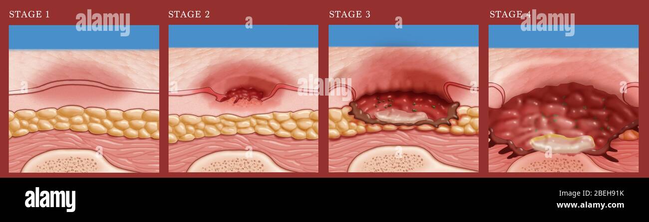 Escarre stade 3 Banque de photographies et d’images à haute résolution - Alamy