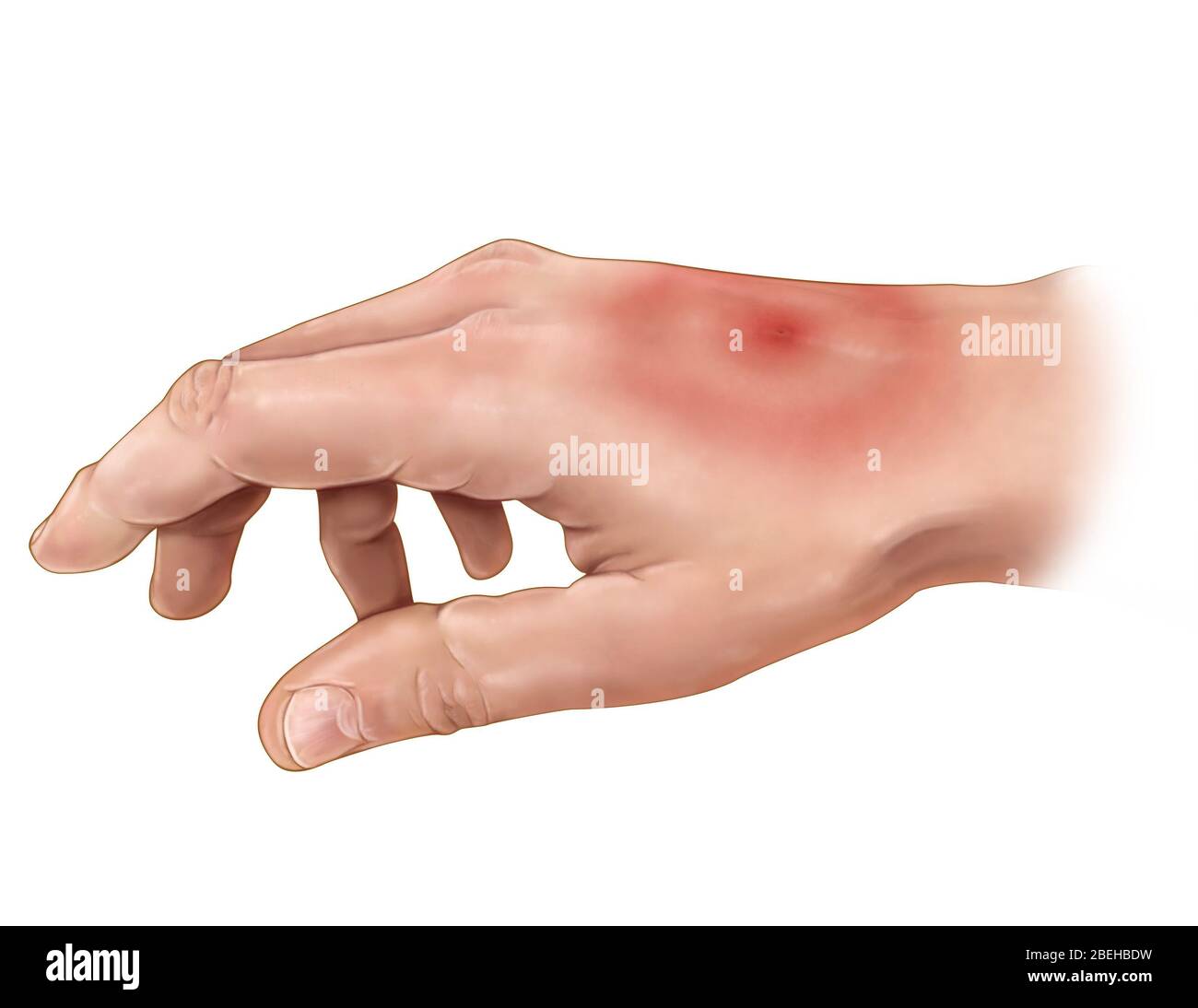 Maladie de peau de la main Banque de photographies et d’images à haute ...
