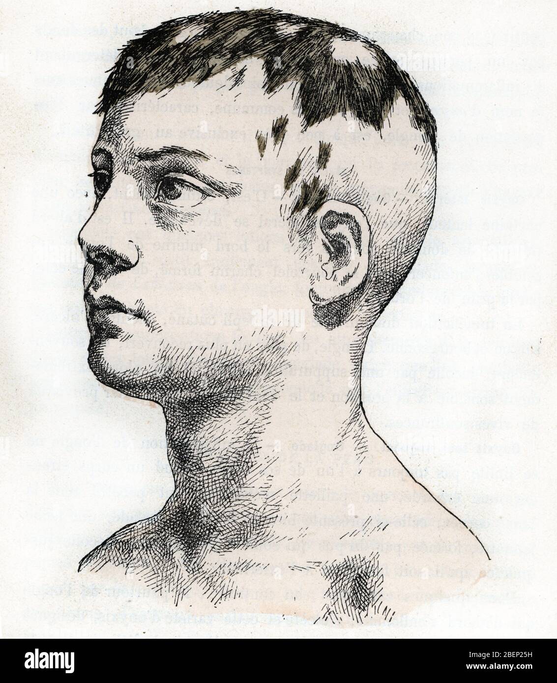 Tinea Capitis Banque d'image et photos - Alamy