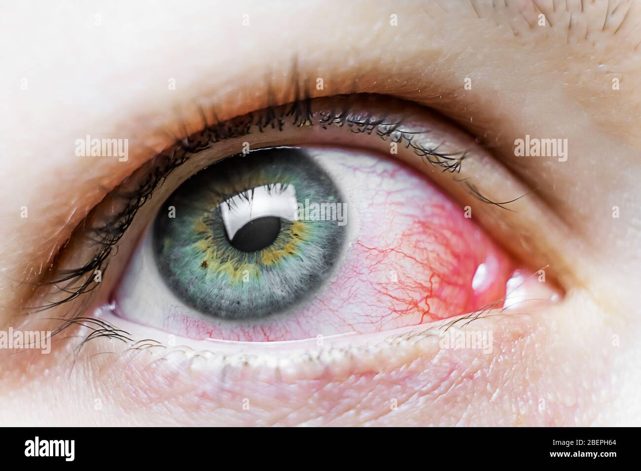Gros plan sur un œil rouge effusion de sang. Blepharitis viral ...