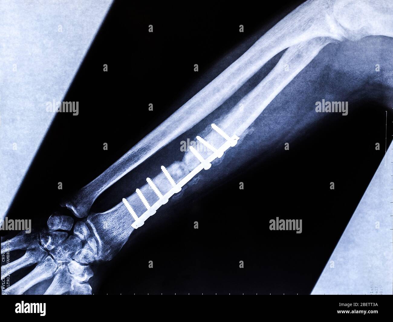 Fracture Of Radius Banque d'image et photos - Page 2 - Alamy