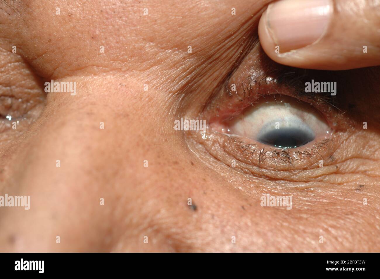 Arcus senilis Banque de photographies et d’images à haute résolution ...