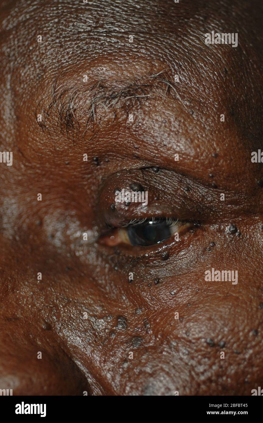 Le trichiasis Banque de photographies et d’images à haute résolution ...