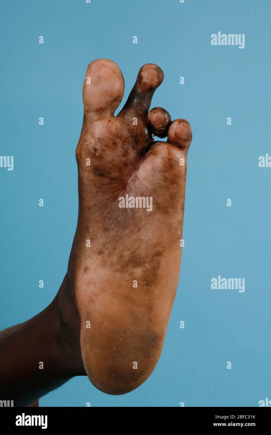 Gros plan sur le pied d'un sufferateur de mycetome. Notez qu'un orteil ...