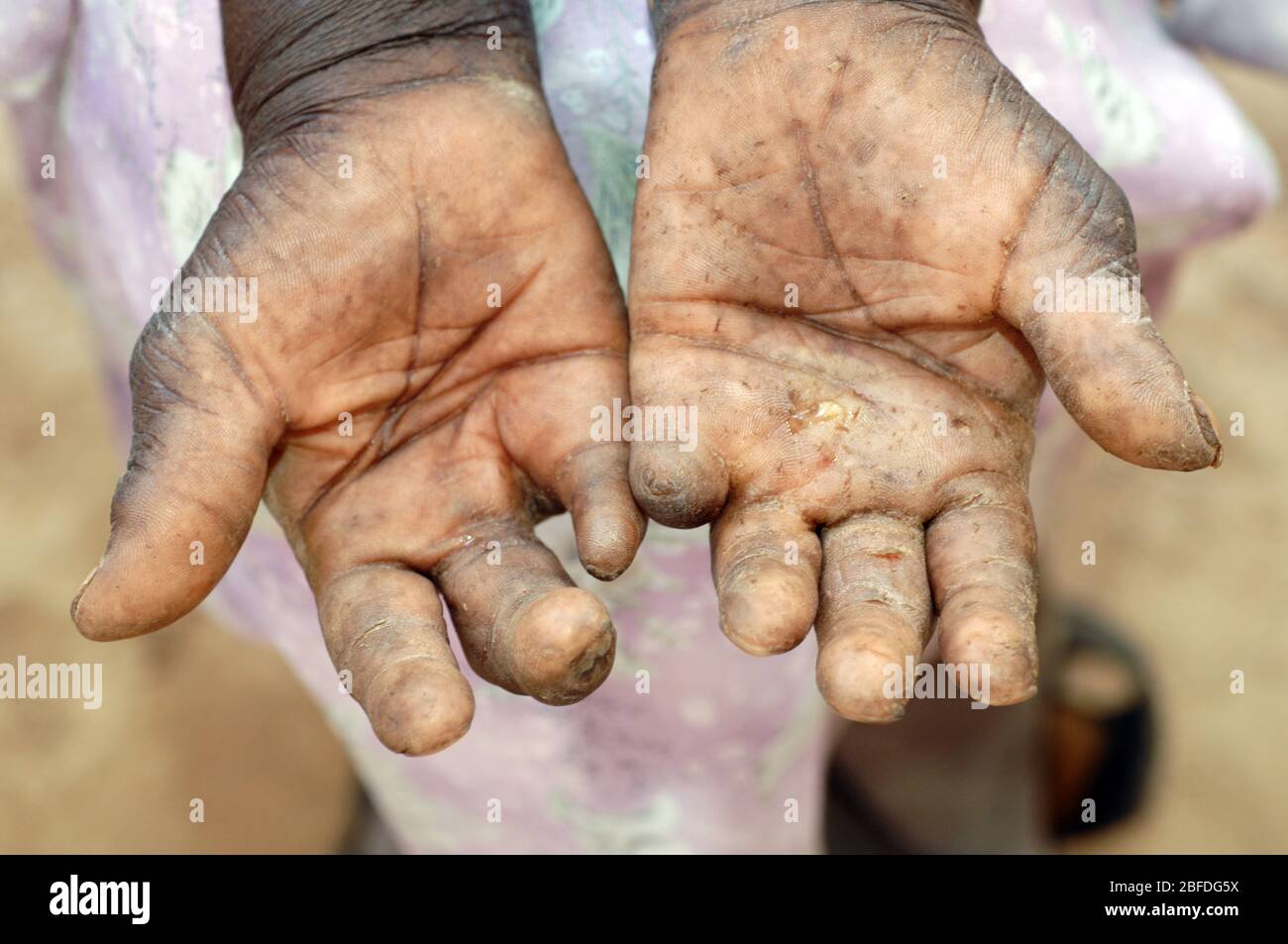 Maladie de hansen Banque de photographies et d’images à haute ...