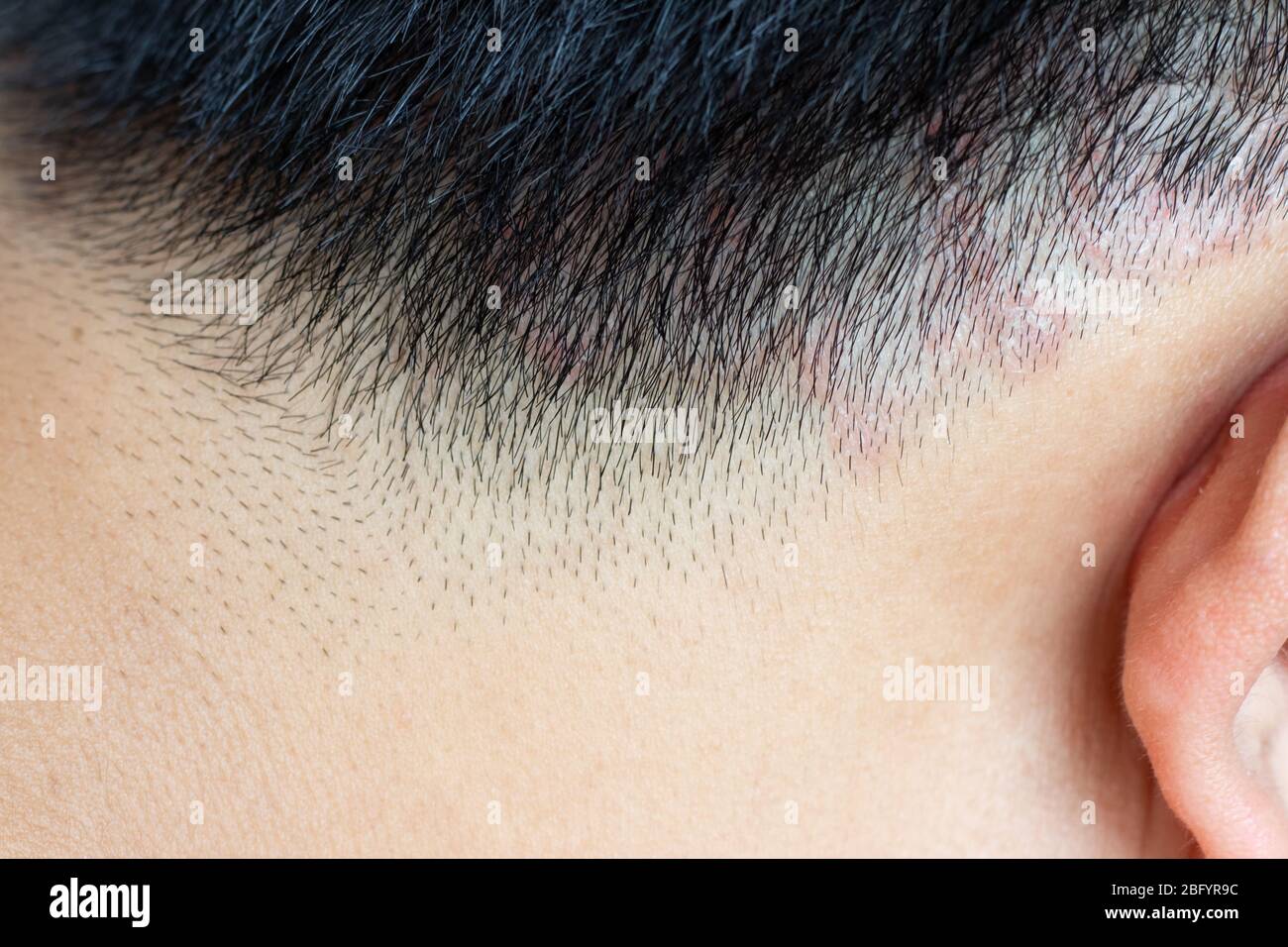 Fermé de la Teigne (tinea) sur la tête de l'homme asiatique (dermatite ...