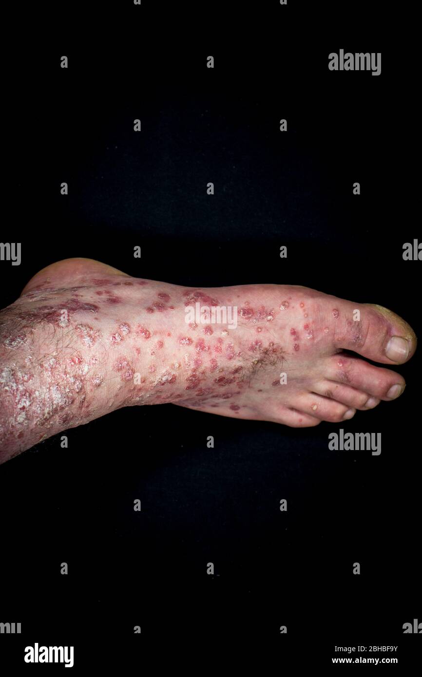 Psoriasis au pied Banque de photographies et d’images à haute ...