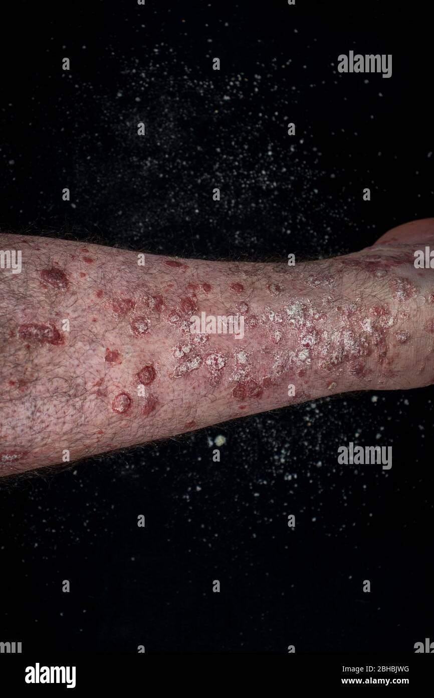 Le psoriasis Banque de photographies et d’images à haute résolution - Alamy