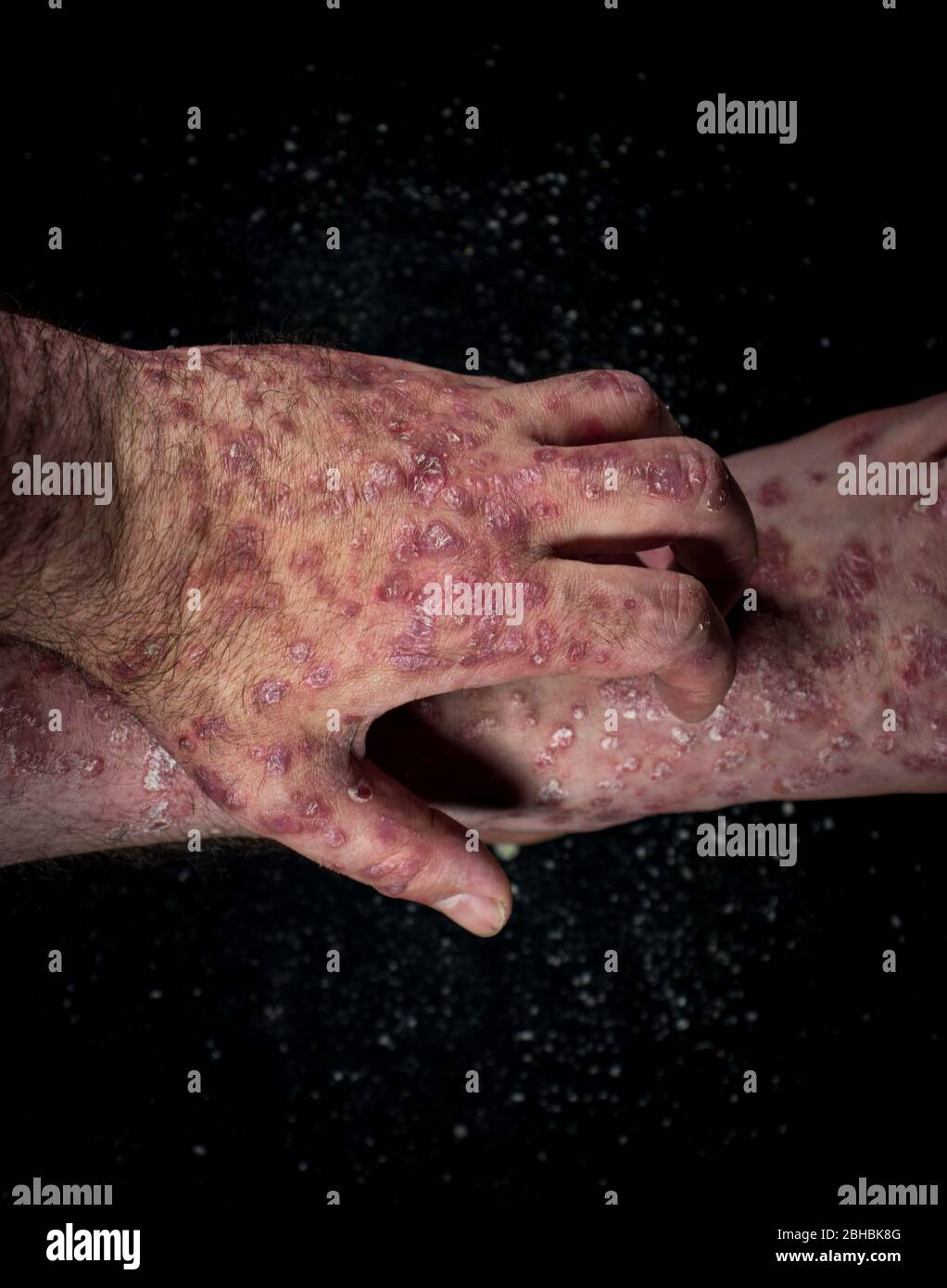 Psoriasis foot Banque de photographies et d’images à haute résolution ...