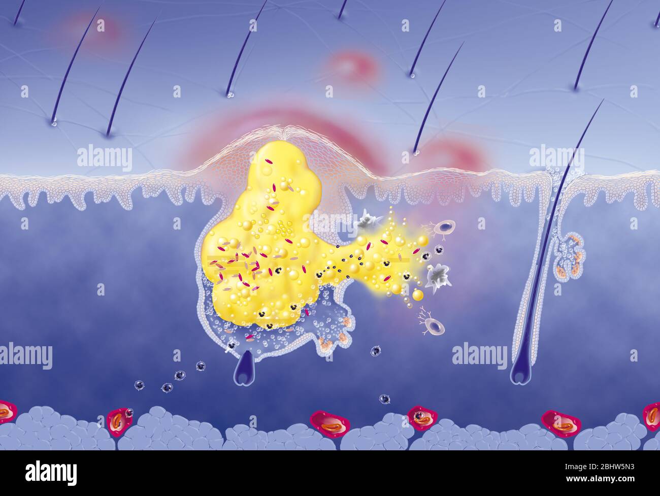 Acné autour de la follicule pileux, hypersécrétion sébacée ...