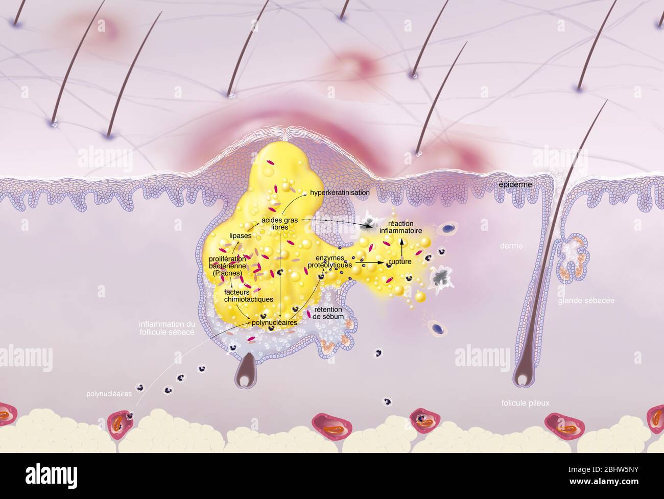 Acné autour de la follicule pileux, hypersécrétion sébacée ...