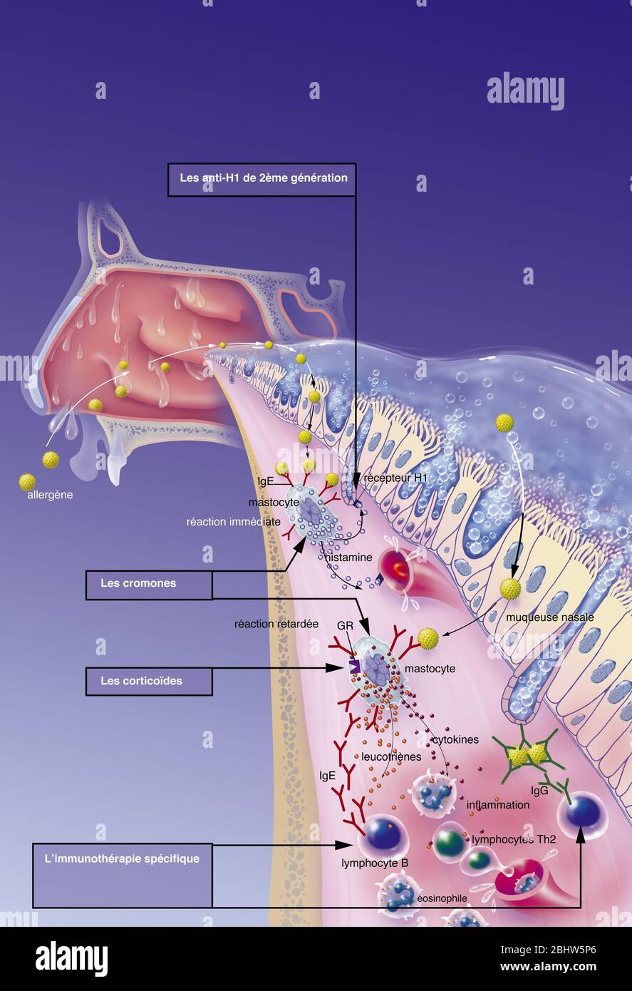 Congestion nasale, détails de la muqueuse nasale, allergène, réaction ...