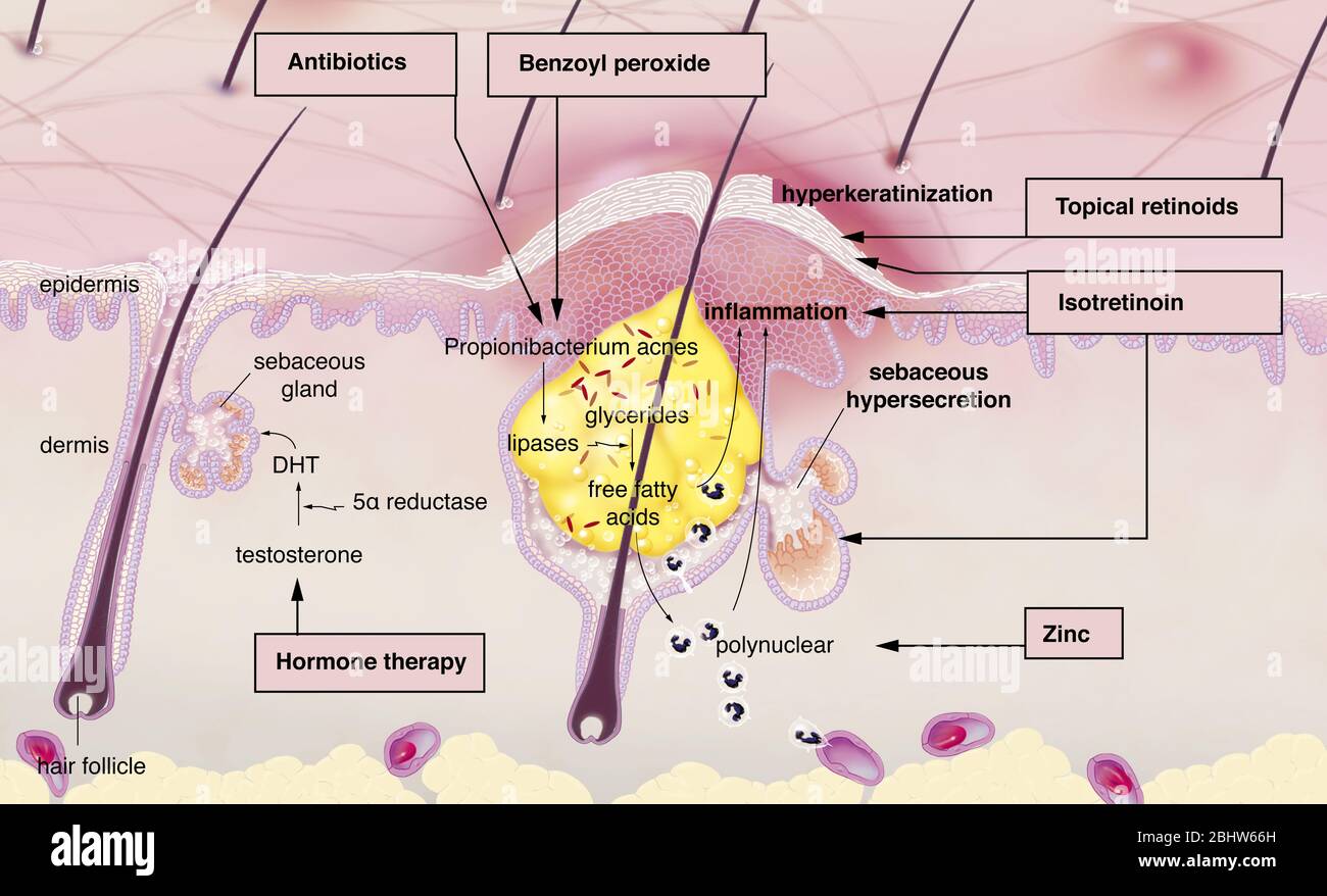Acné autour du follicule pileux avec inflammation, hypersécrétion ...