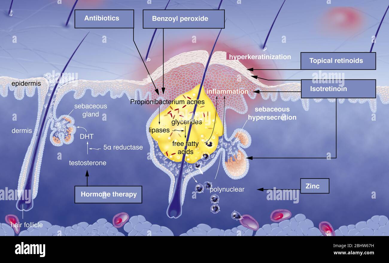 Acné autour du follicule pileux avec inflammation, hypersécrétion ...