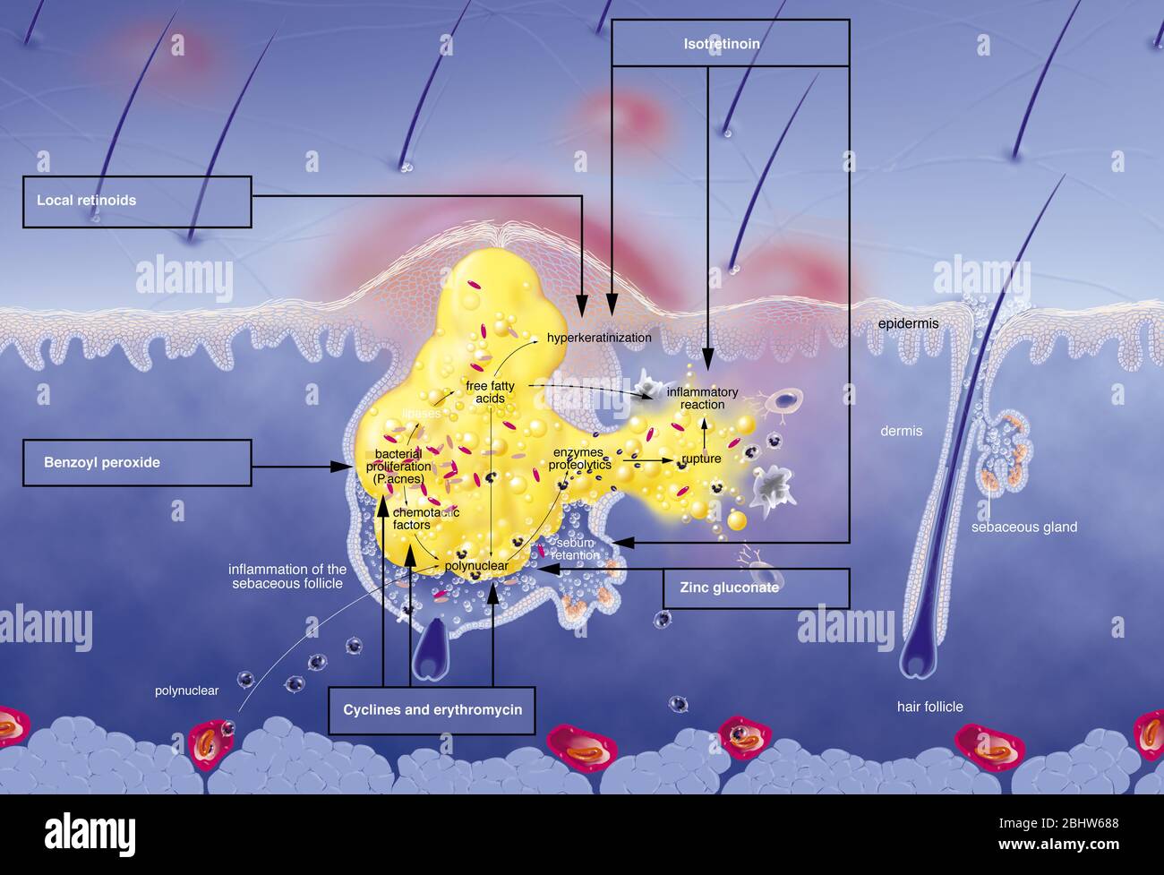 Acné autour de la follicule pileux, hypersécrétion sébacée ...