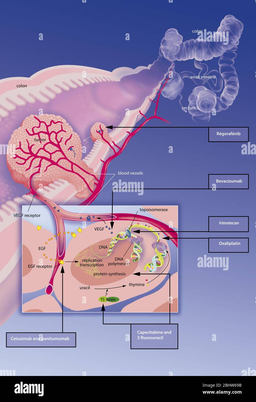Cancer colorectal et ses traitements. Au-dessus de la droite, le côlon ...
