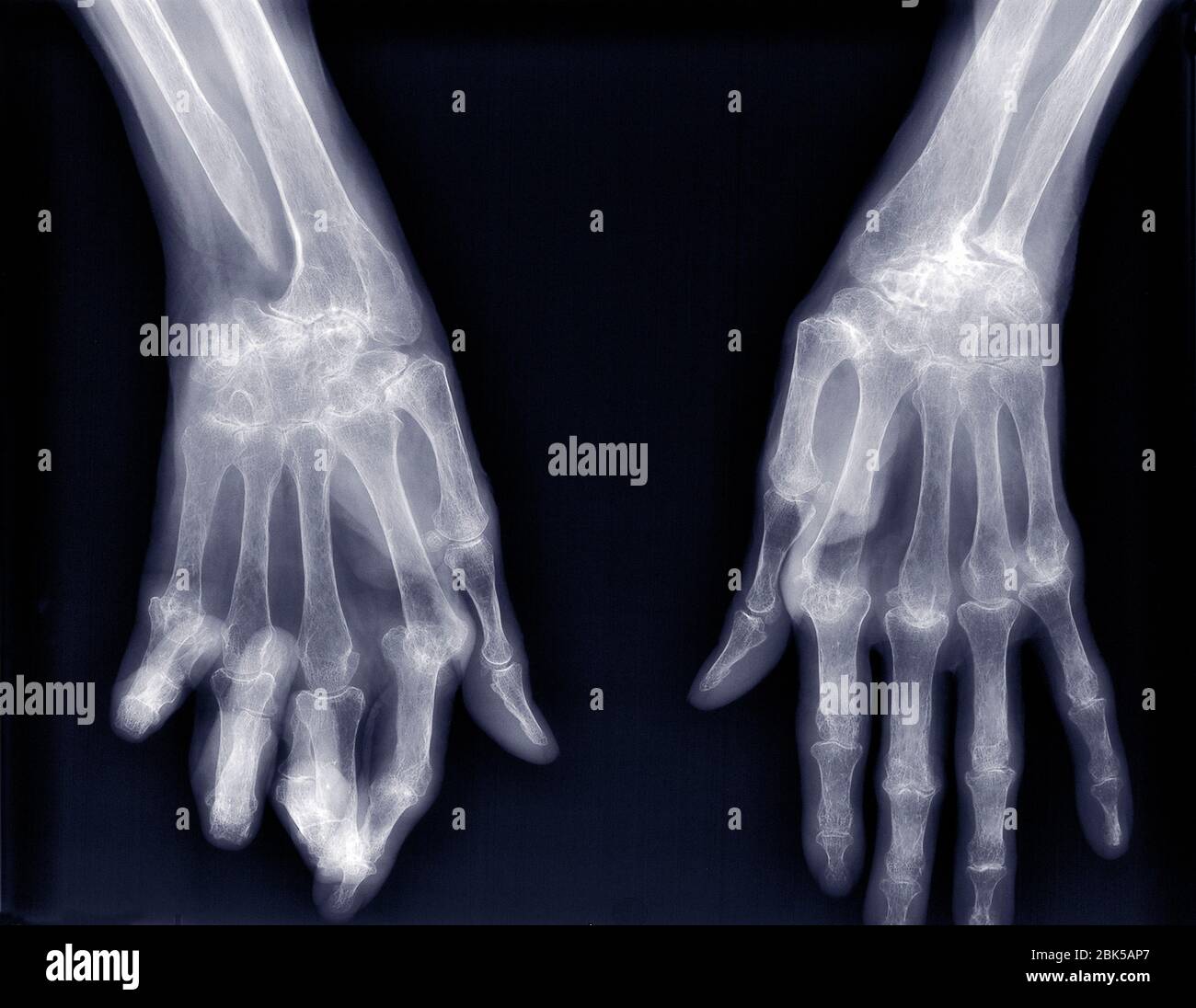 Radiographie des mains arthrose Banque de photographies et d’images à ...