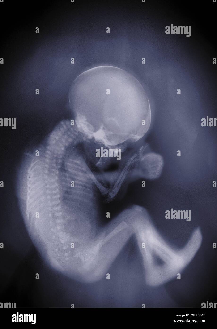 Bébé en position fœtale, radiographie Photo Stock - Alamy