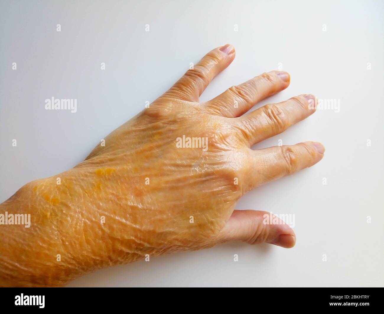 Maladies dermatologiques Banque de photographies et d’images à haute ...