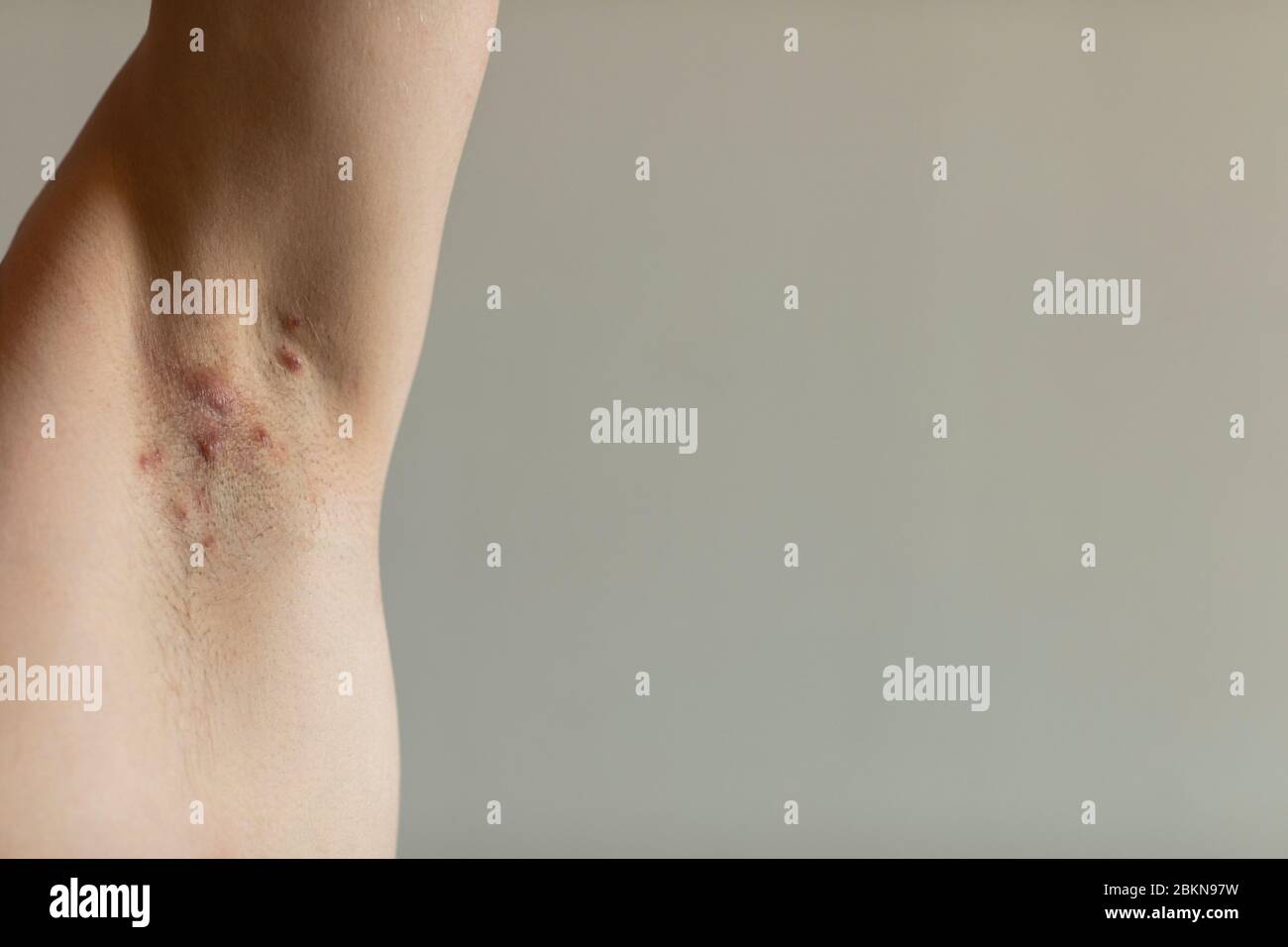 Hidradenitis suppurativa Banque de photographies et d’images à haute ...