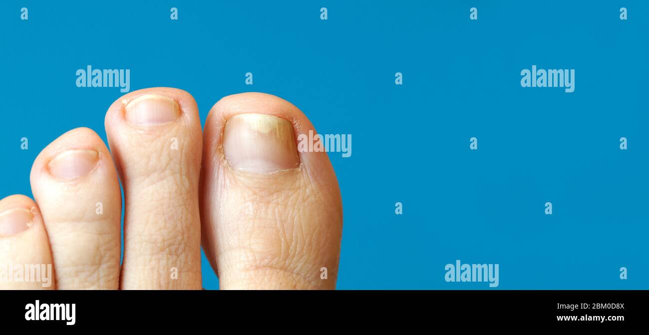 Psoriasis nails Banque de photographies et d’images à haute résolution ...