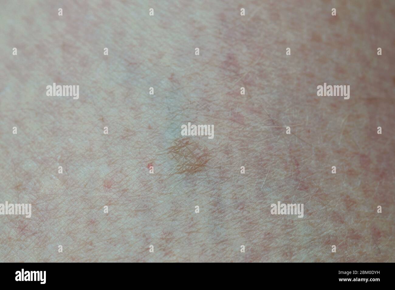 Squamous cell carcinoma Banque de photographies et d’images à haute ...