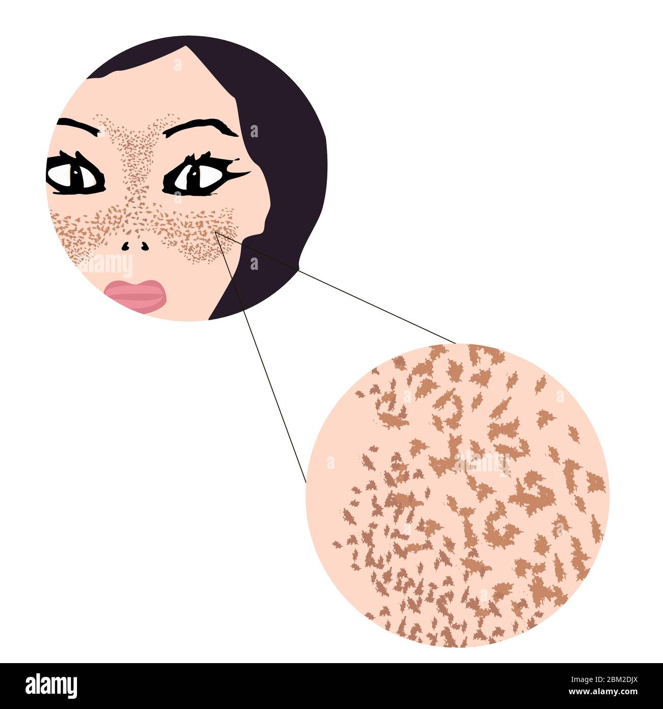 Se freckle sur le visage. Pigmentation sur la peau. Un point pigmenté ...