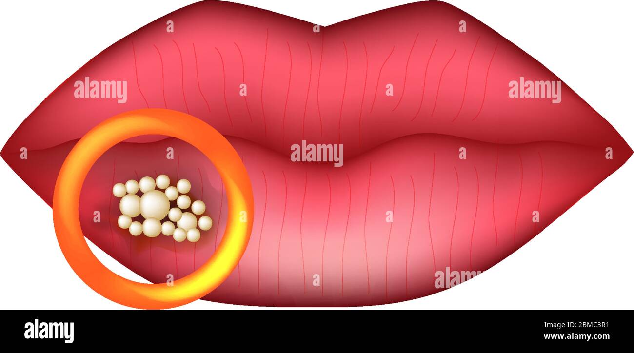 Herpes zoster virus Banque d'images vectorielles - Alamy