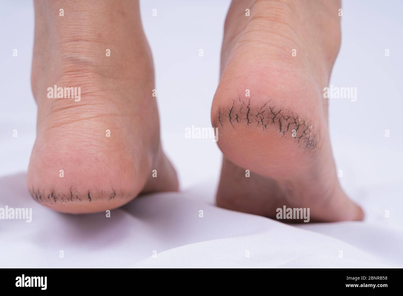 Gros plan sur un talon sec et fissuré avec une peau noire sur fond ...