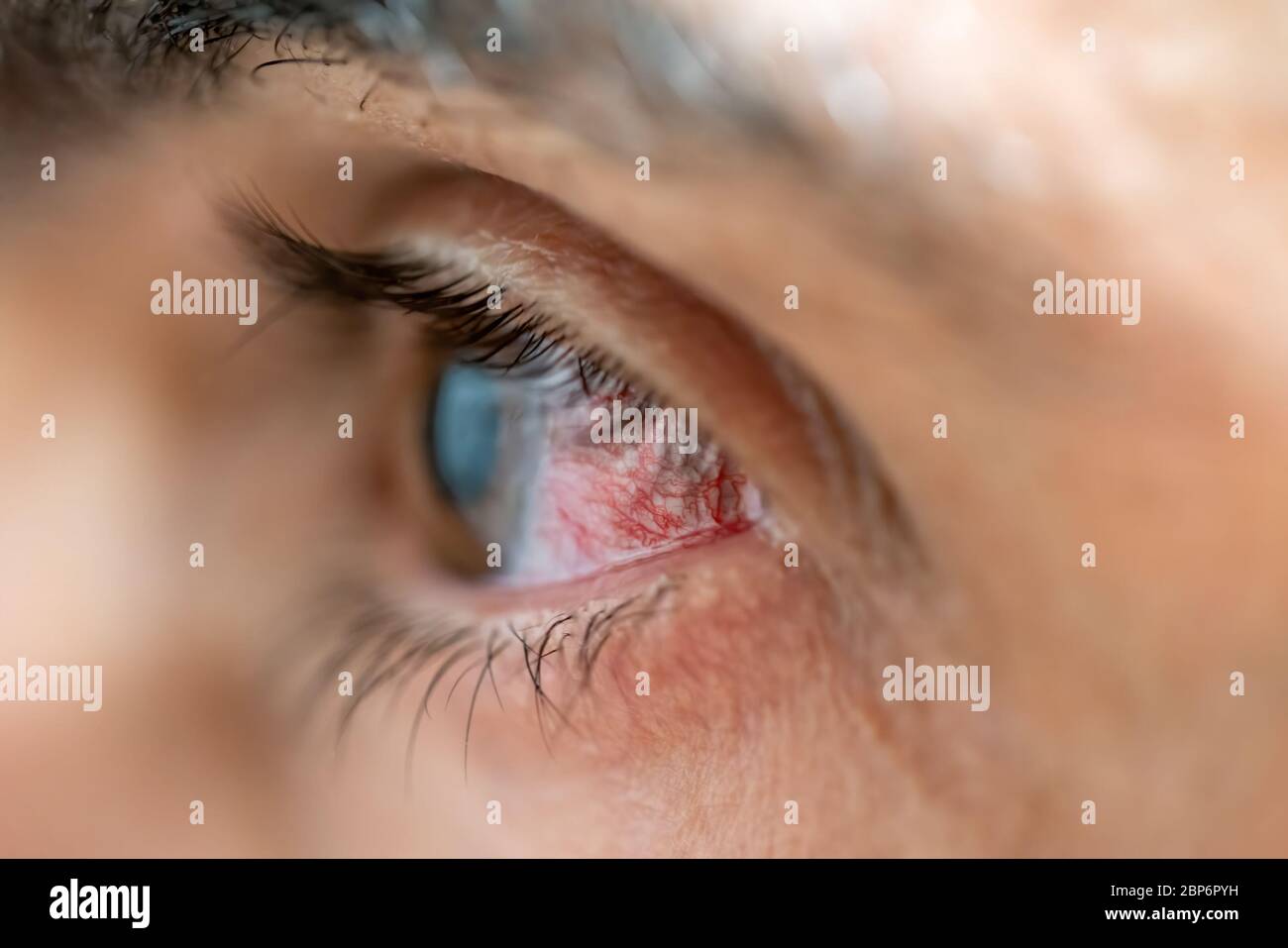 Conjunctivitis veins Banque de photographies et d’images à haute ...