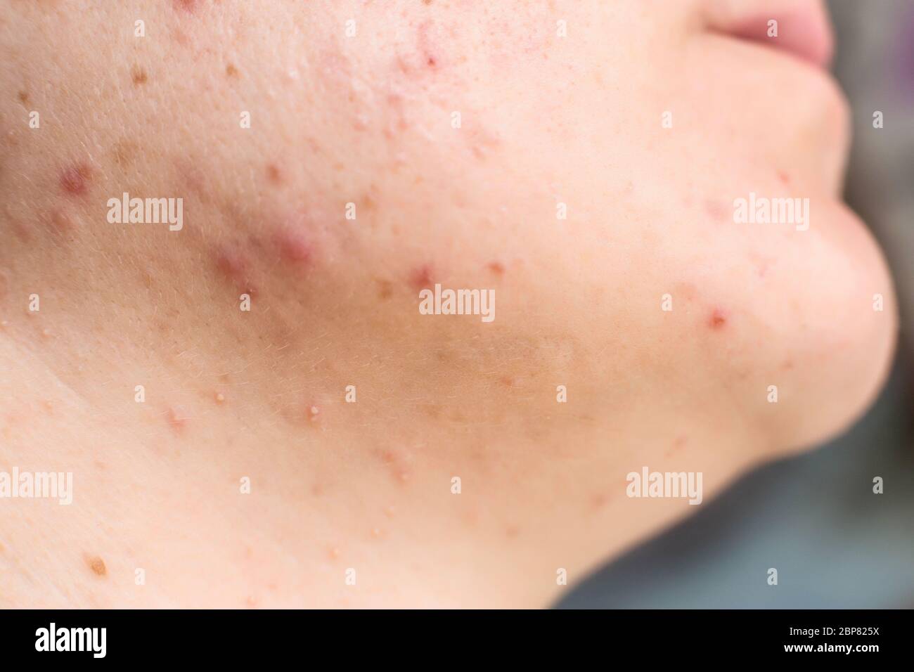 Acné rouge et une éruption cutanée sur le visage et le cou d'une fille ...
