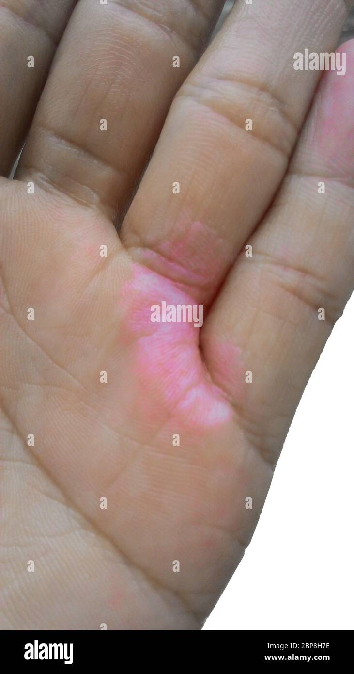 Eczéma des mains Banque de photographies et d’images à haute résolution ...