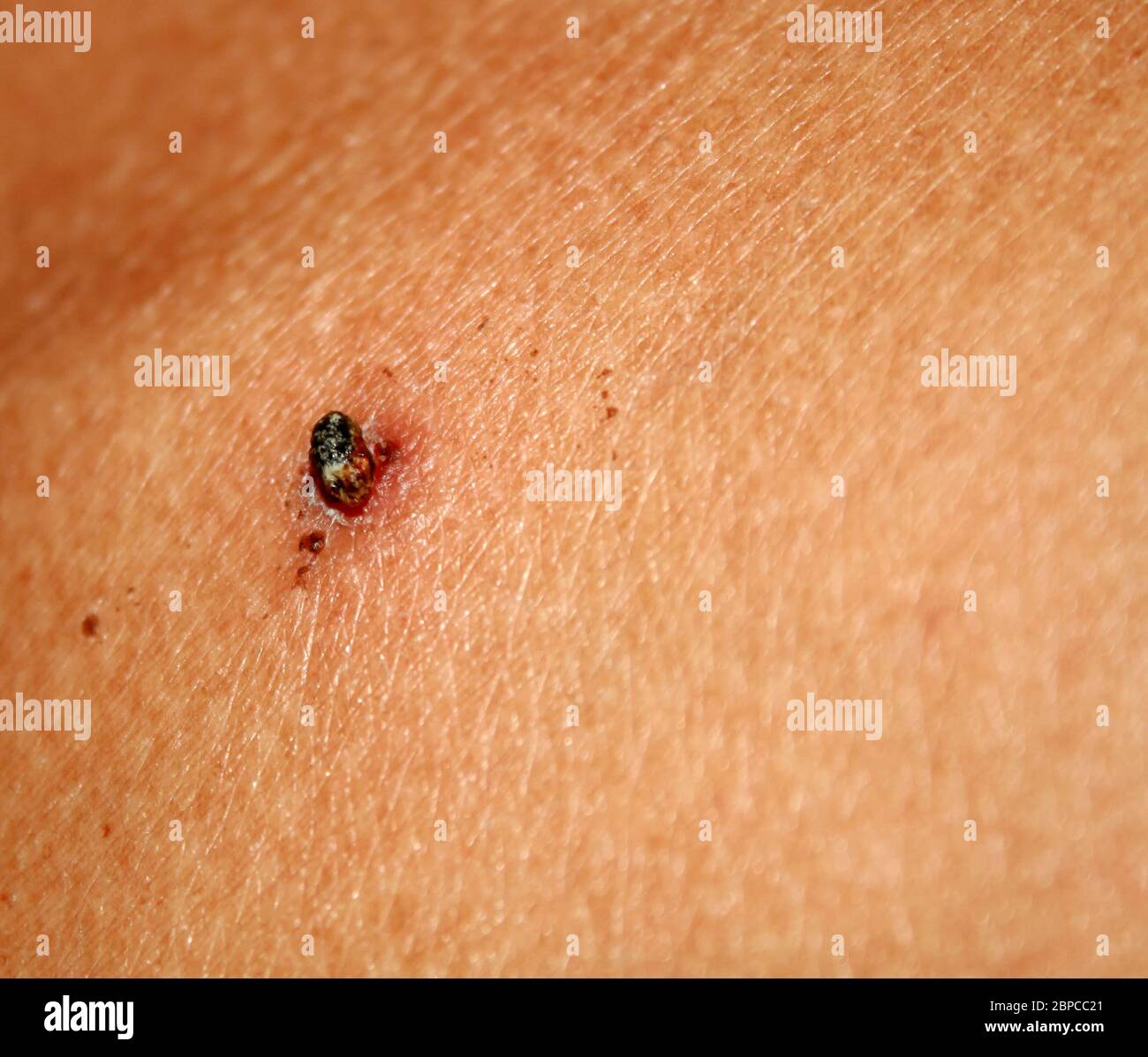 Benign nevus skin dermatology Banque de photographies et d’images à ...