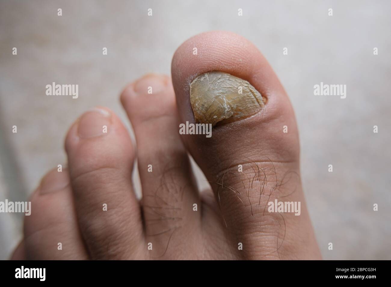 Homme doigt malade onycho mycose ongles fermer,soins dermatologiques ...