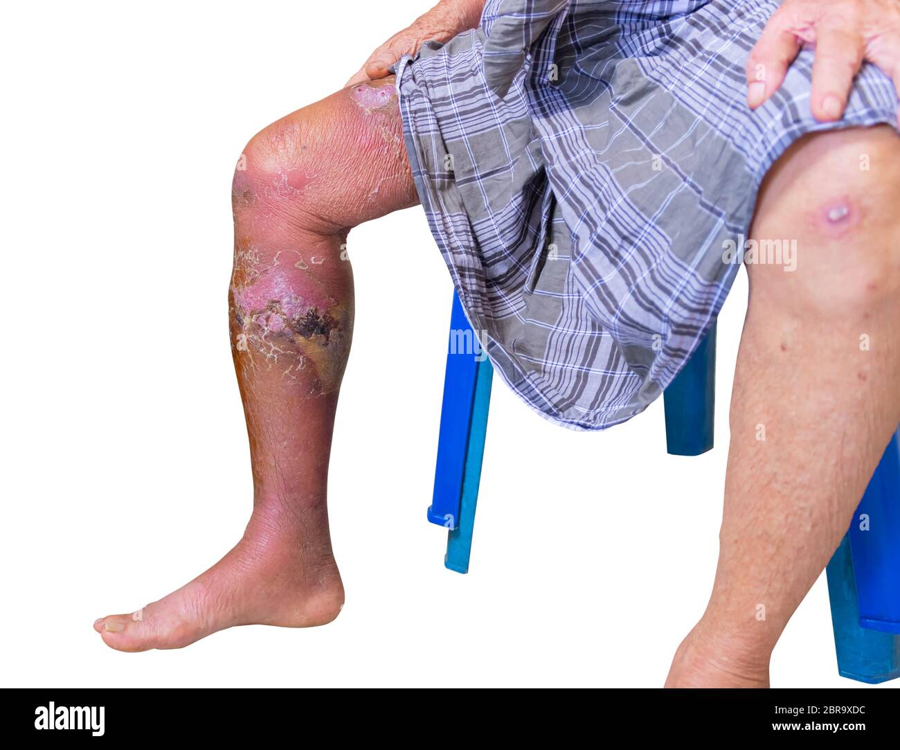 Erysipelas infection bactérienne sous la jambe de peau personnes âgées ...