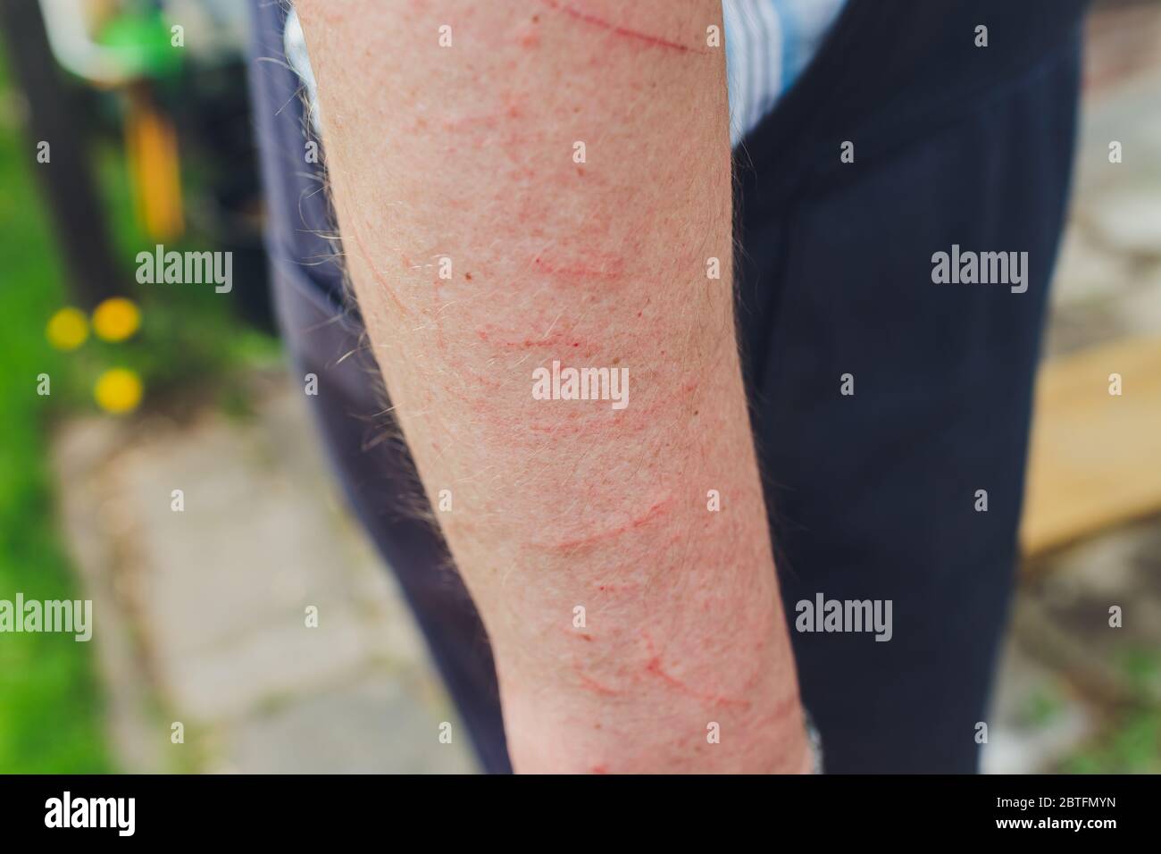 Problèmes de maladies allergiques cutanées, dermatite de contact de ...
