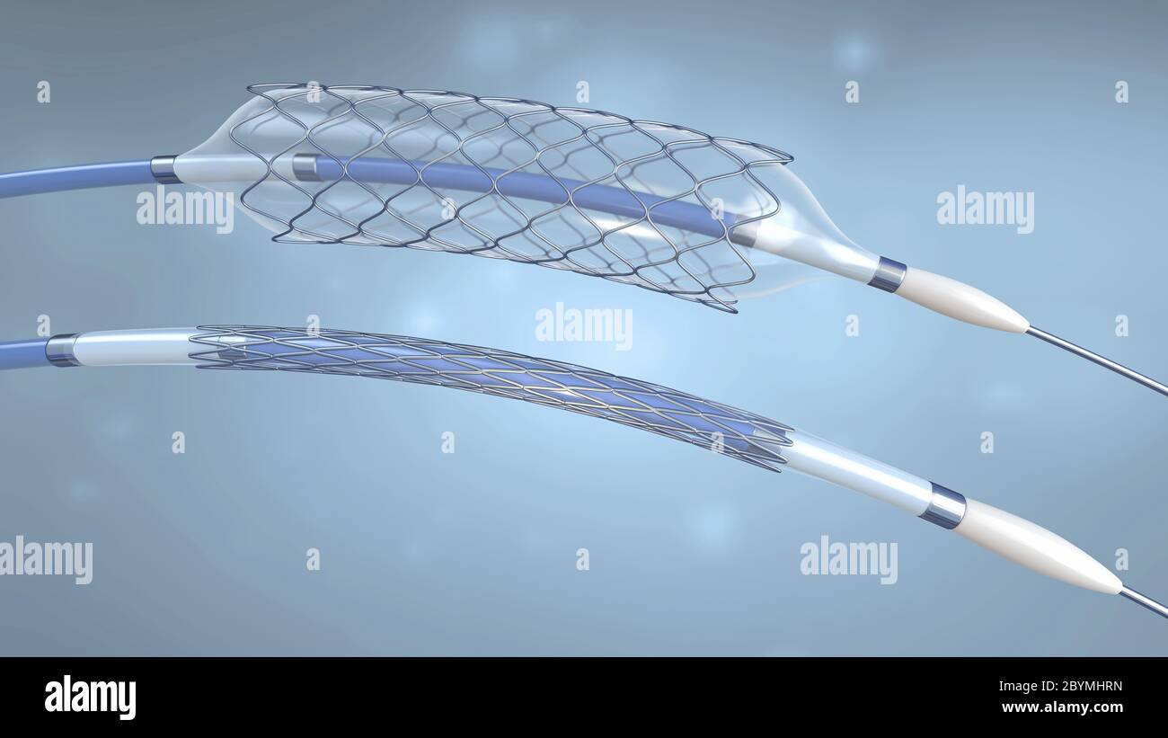 Stent et cathéter pour implantation dans les vaisseaux sanguins avec ...