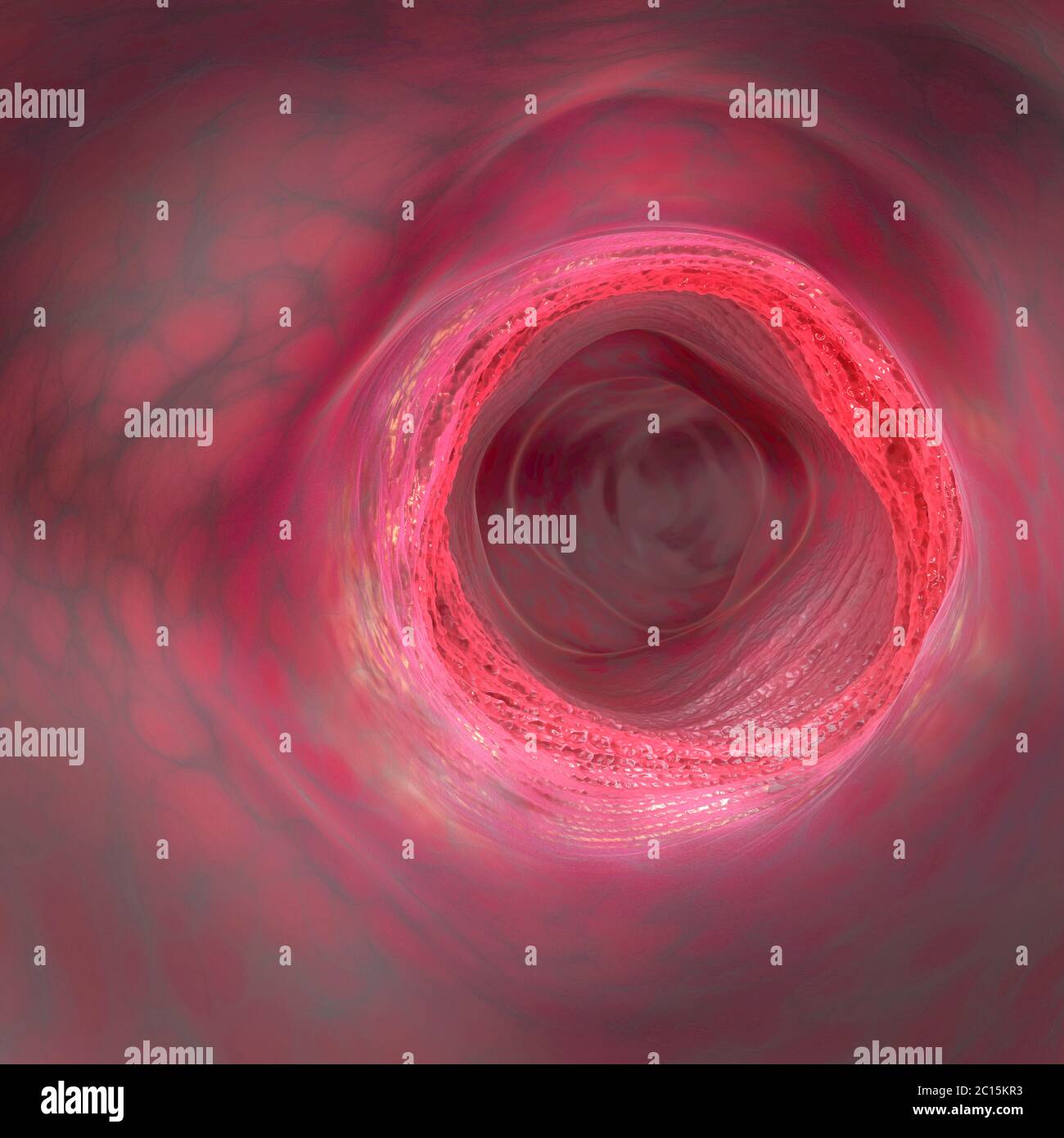 3d illustration d'un intestin une inflammation à l'intérieur du côlon ...
