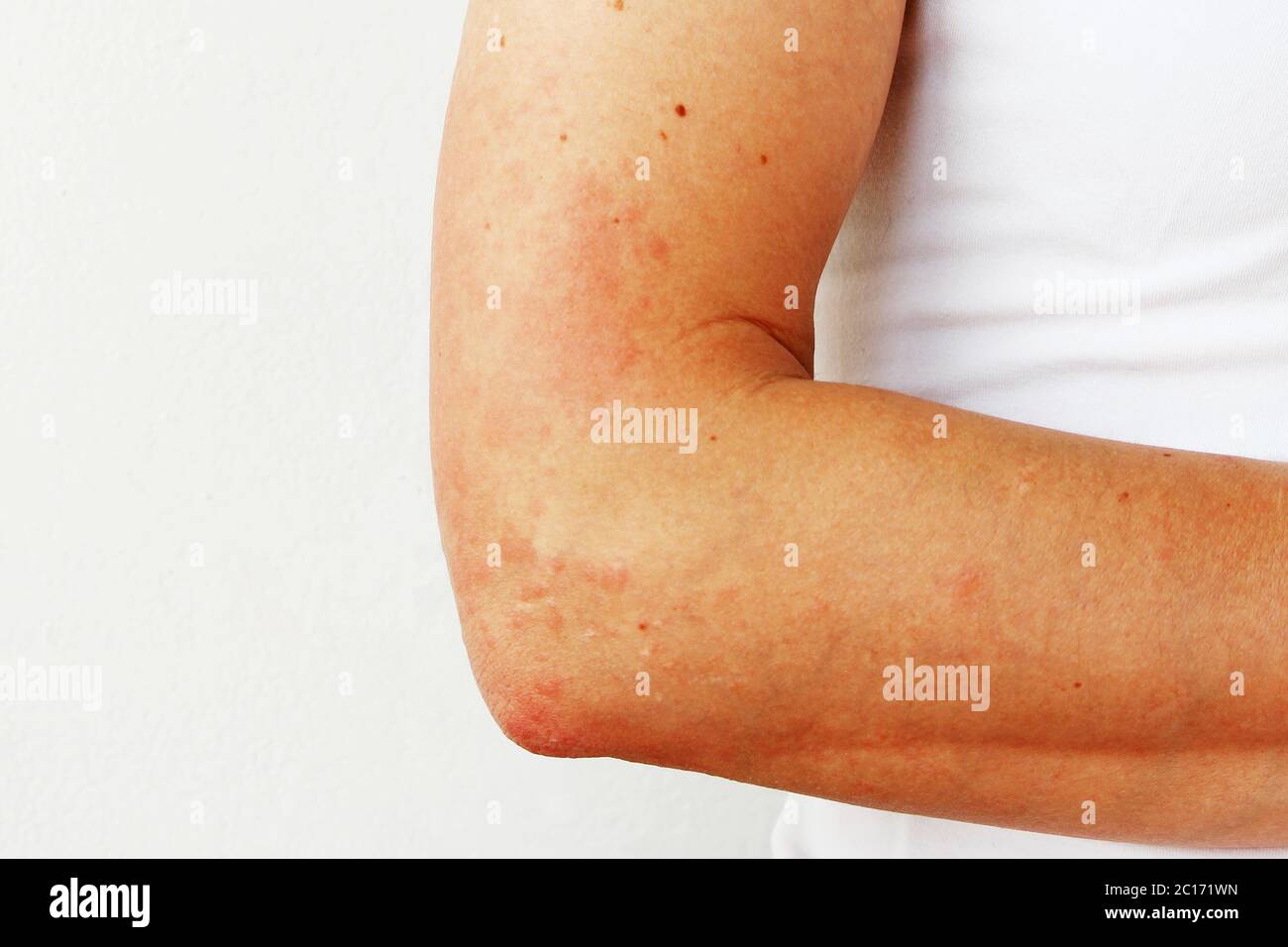 Pustules rouges et vésicules sur la peau de la main comme symptômes de ...