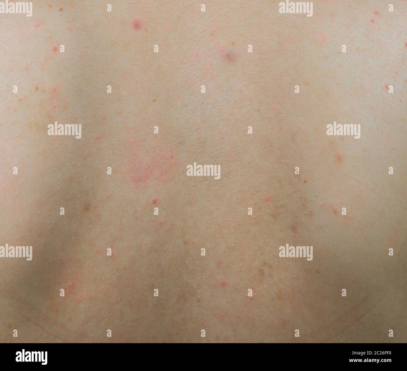 Tache Rouge Peau Sur Cicatrice Banque d'image et photos - Alamy