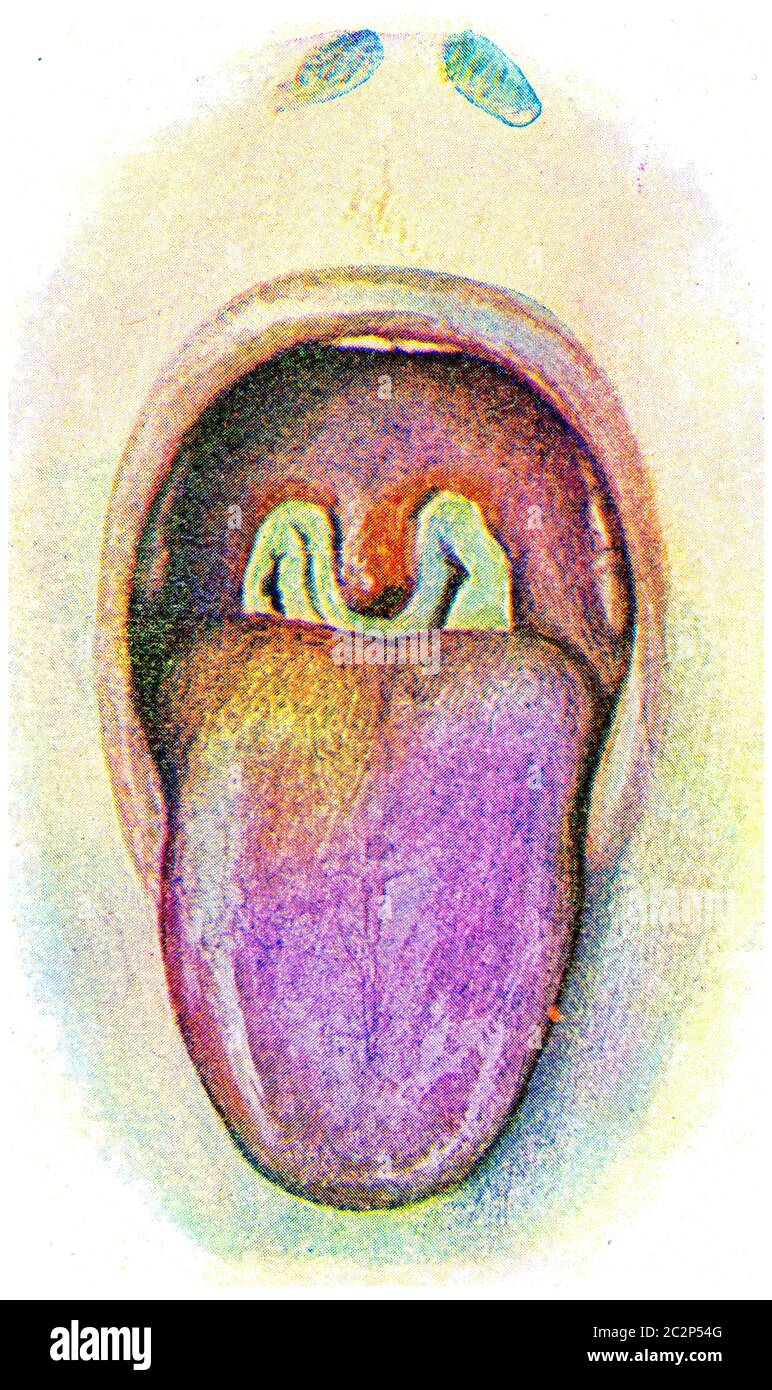 Tonsil membrane Banque d'images détourées - Alamy