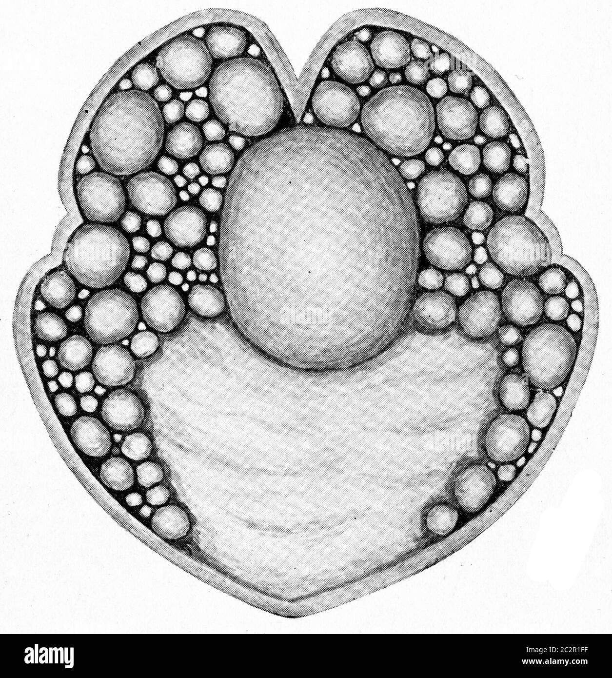 Kyste hydatide, montrant des kystes filles, illustration gravée d ...