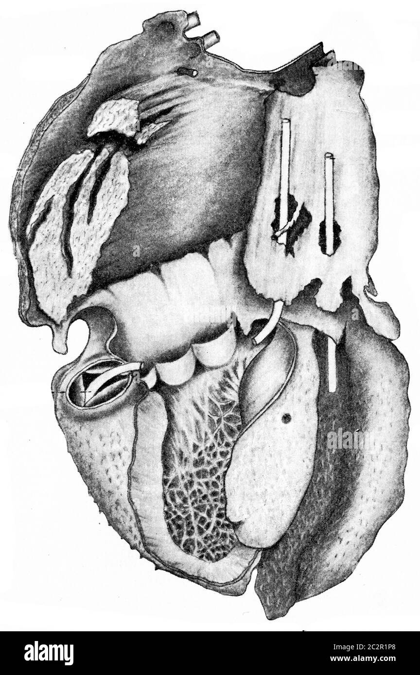 Artery rupture Banque d'images noir et blanc - Alamy