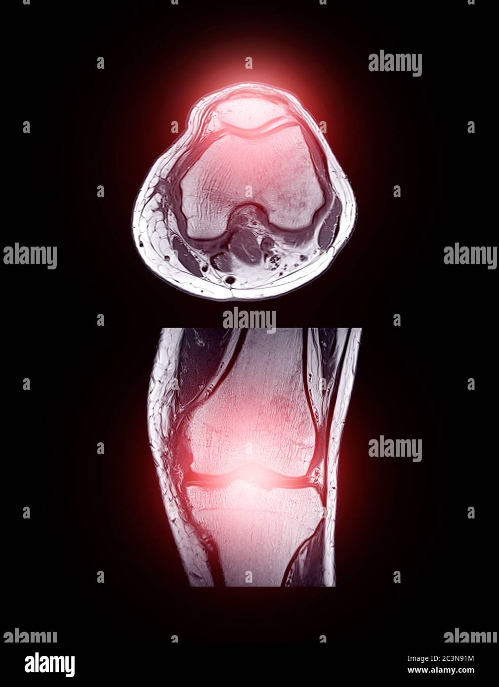 Patella tendon Banque de photographies et d’images à haute résolution ...
