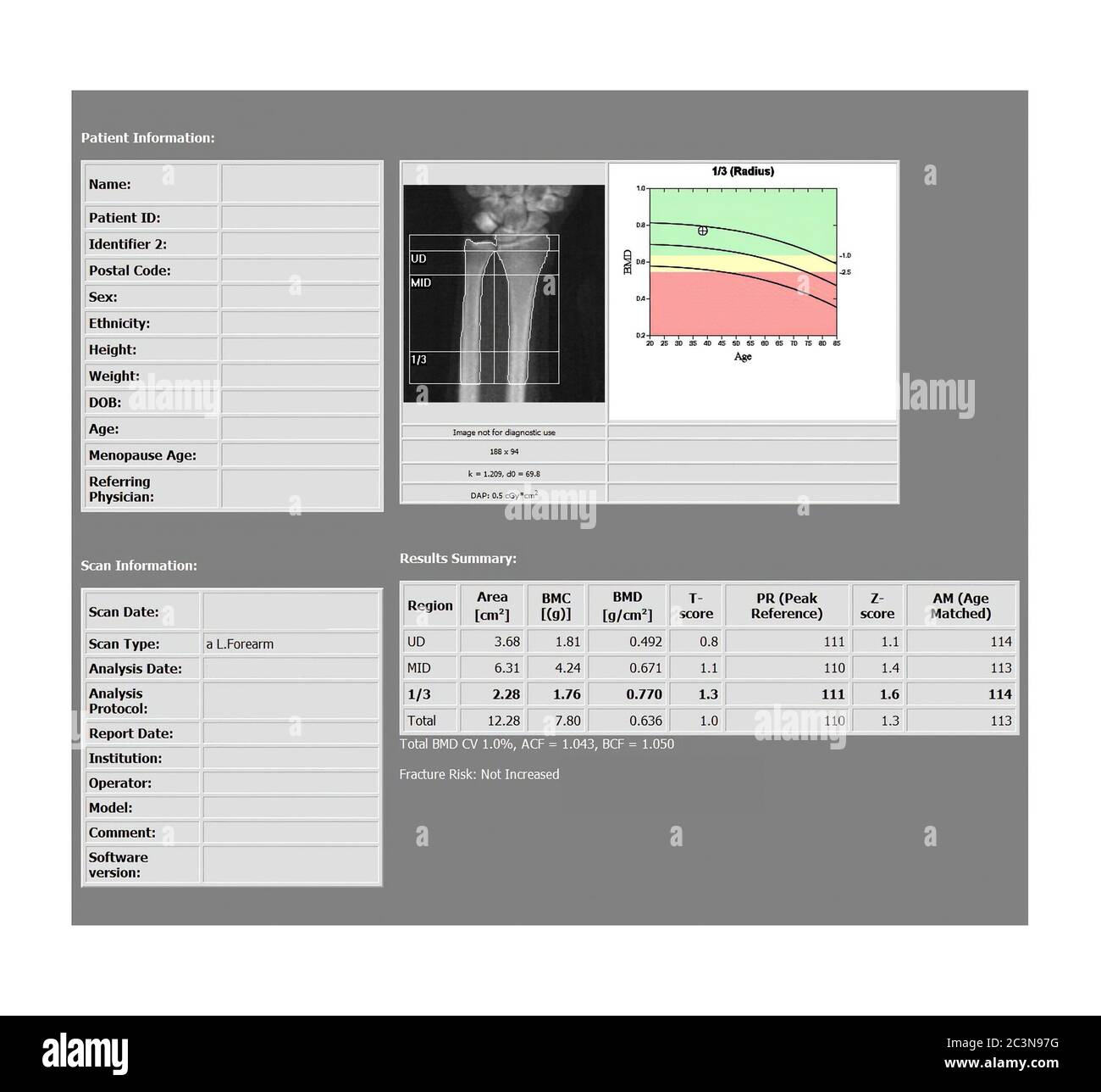 DEXA rapport de densitométrie de l'examen des articulations du poignet ...
