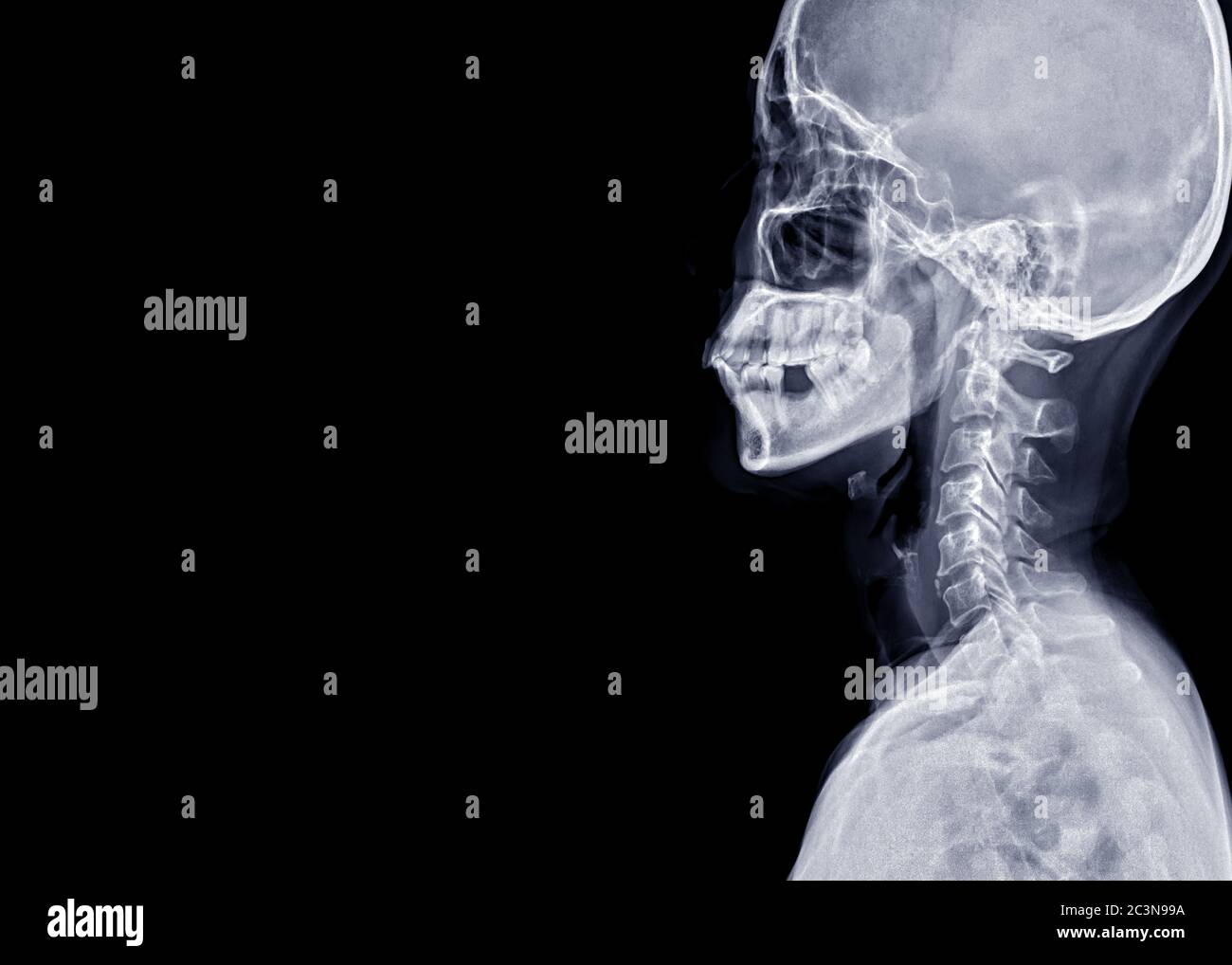 Radiographie du rachis cervical ou radiographie du rachis cervical vue ...