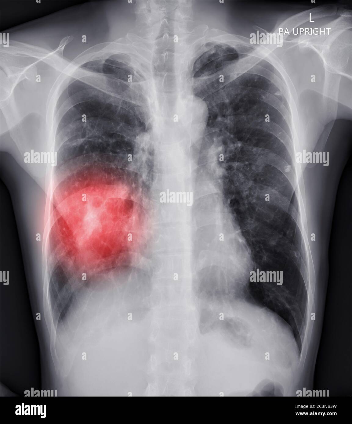 Radiographie thoracique ou radiographie du thorax humain montrant la ...