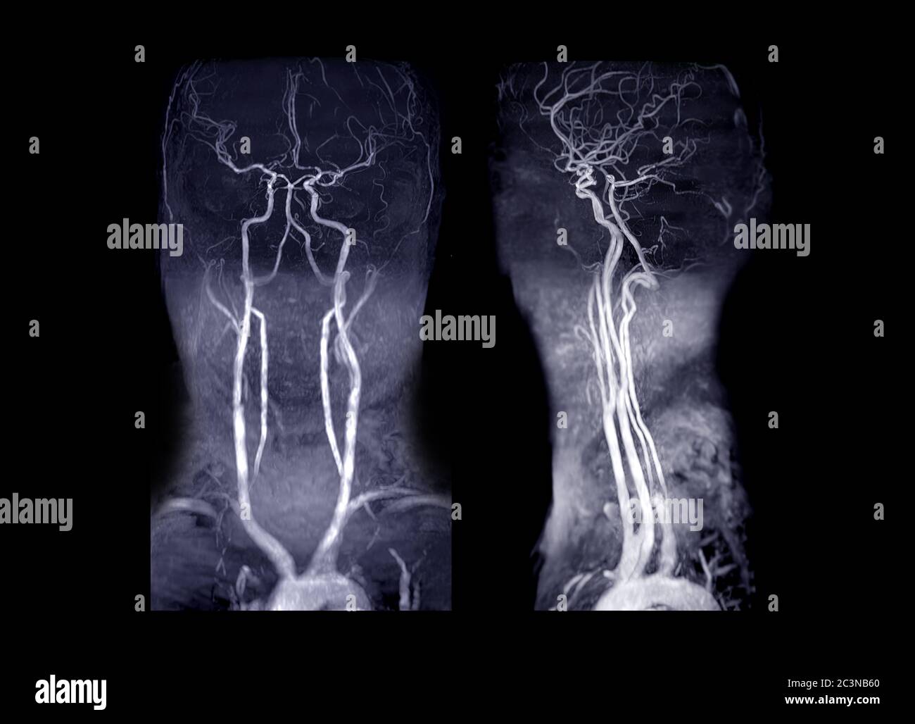 ARM angiographie par résonance magnétique ou cérébrale ( ARM ) de l ...