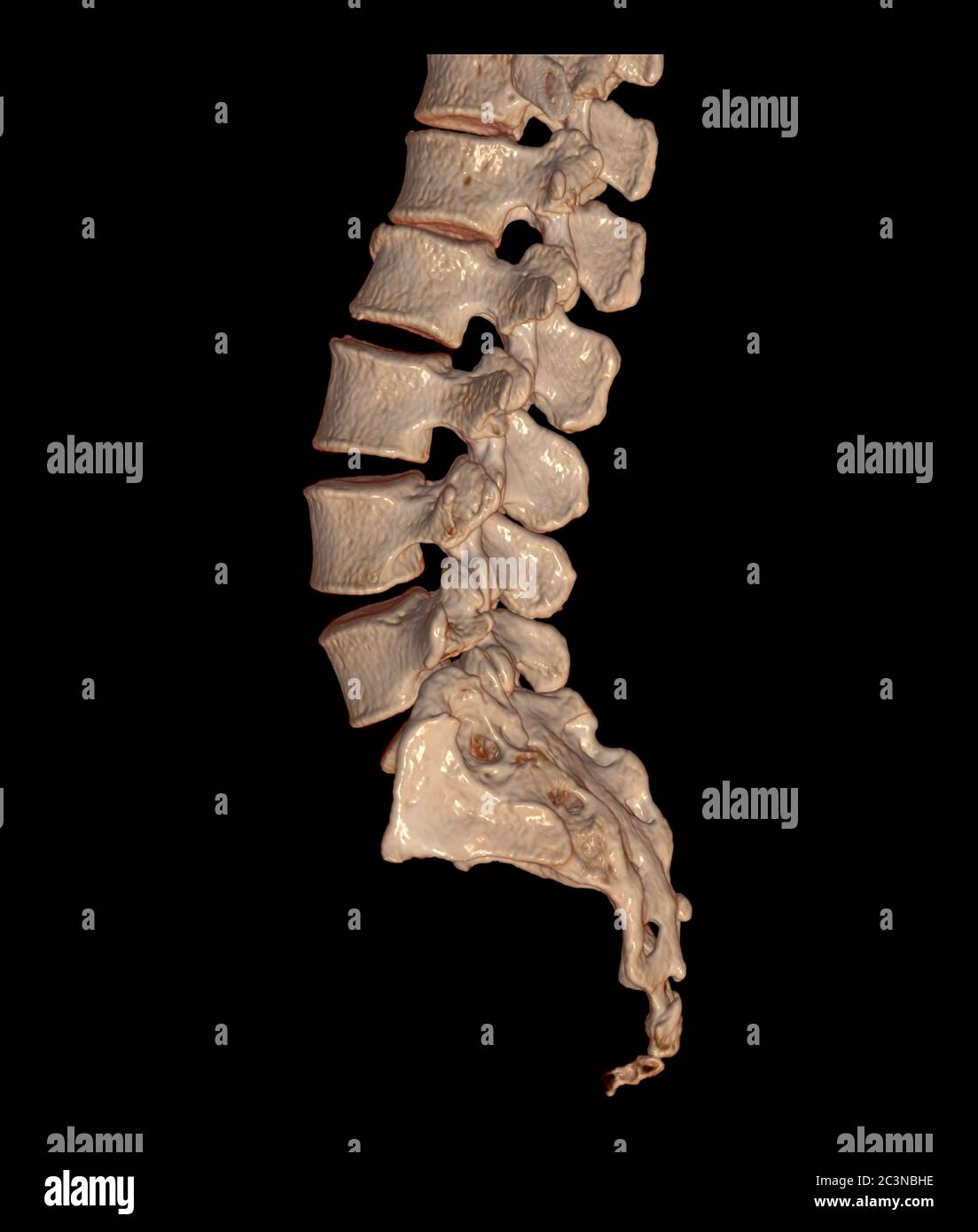 Image de rendu 3D CT lombaire ou rachis L-S vue latérale montrant les fractures de compression ...